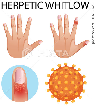Herpetic Whitlow Finger Herpetic Whitlow WikEM