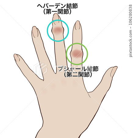 Heberden's node and Bouchard's node - Stock Illustration [106280838 ...