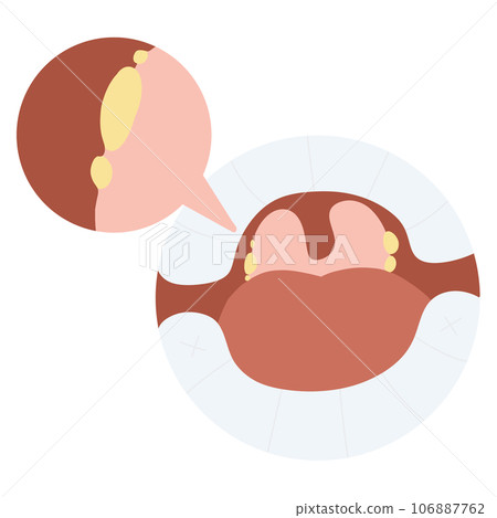 Oral Tonsils icon - Stock Illustration [106887762] - PIXTA