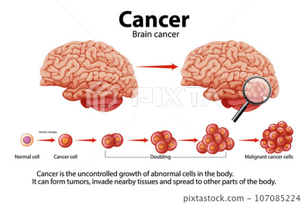 Medical Anatomy Infographic: Brain Cancer and... - Stock Illustration ...