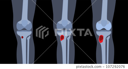Tibia bone osteomyelitis - Stock Illustration [107292076] - PIXTA