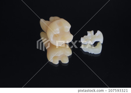 lower molar ceramic inlay - Stock Photo [107593321] - PIXTA