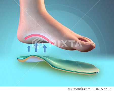 Foot arch support - Stock Illustration [107978322] - PIXTA