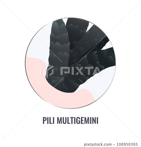 Pili multigemini hair disorder in close up-插圖素材 [108950393] - PIXTA圖庫