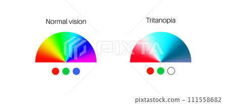 Tritanopia and tritanomaly - Stock Illustration [111558682] - PIXTA