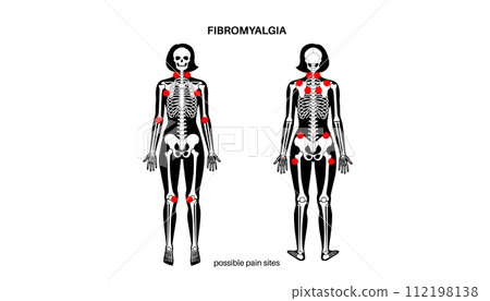 Fibromyalgia medical poster - Stock Illustration [112198138] - PIXTA
