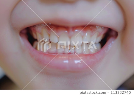Close-up photo of asian child's teeth - Stock Illustration [113232740 ...