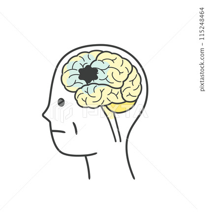 Illustration of parts of the brain damaged by... - Stock Illustration ...