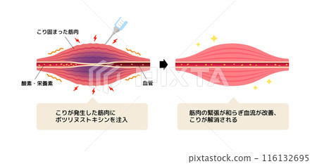 Mechanism of relieving stiffness through Botox... - Stock Illustration ...