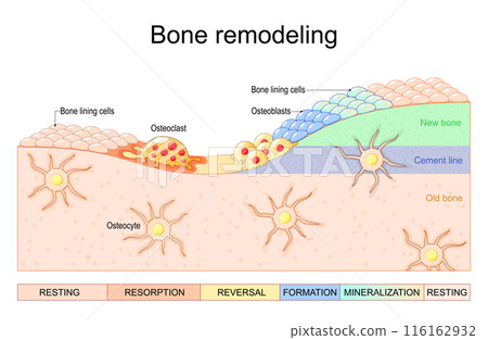 Bone remodeling process. Close-up of... - Stock Illustration [116162932 ...