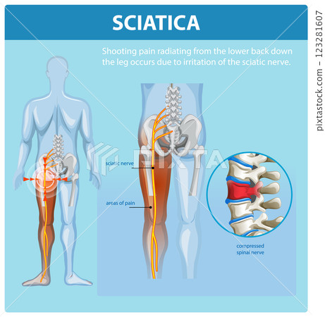 Understanding Sciatica and Its Symptoms - Stock Illustration [123281607] - PIXTA