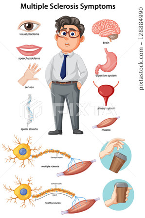 Vector Illustration of Multiple Sclerosis...-插圖素材 [128884990] - PIXTA圖庫